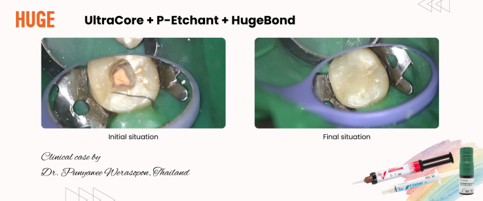 Reliable Posterior Core Build-up with UltraCore: Clinical Case on Tooth ...
